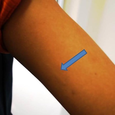 Implanon: A new era of birth control for women | George Herald