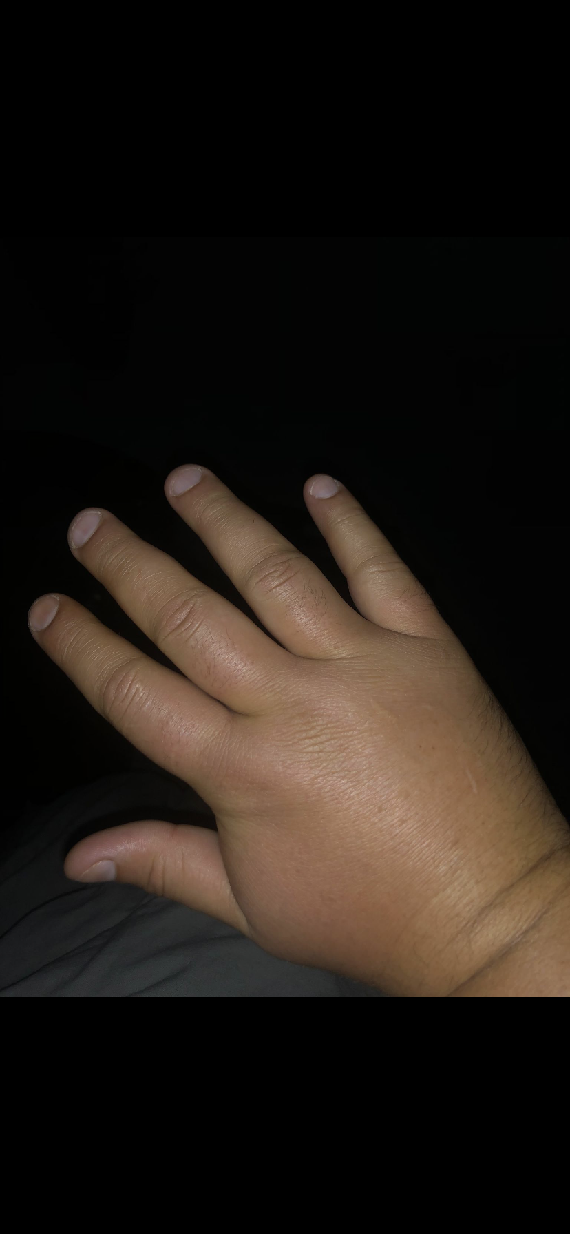 Raising awareness on Hereditary Angioedema (HAE) | Knysna-Plett Herald